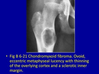 6 bubbly lesions of bone | PPTX