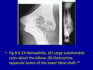6 bubbly lesions of bone | PPTX