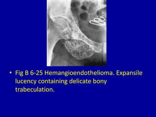 6 bubbly lesions of bone | PPTX
