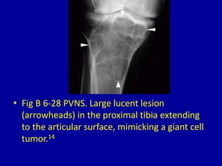 6 bubbly lesions of bone | PPTX