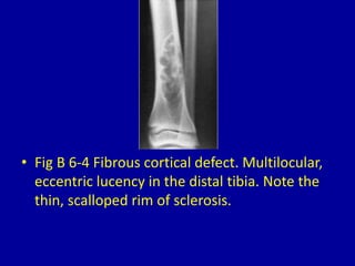 6 bubbly lesions of bone | PPTX