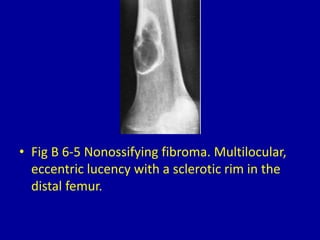 6 bubbly lesions of bone | PPTX
