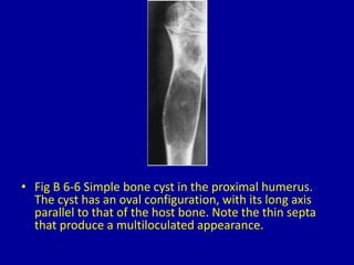 6 bubbly lesions of bone | PPTX