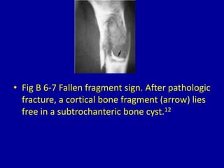 6 bubbly lesions of bone | PPTX