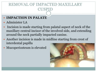 6 canine impaction .pptx