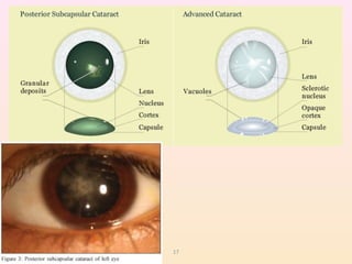 6cataract-170310120227.pdf