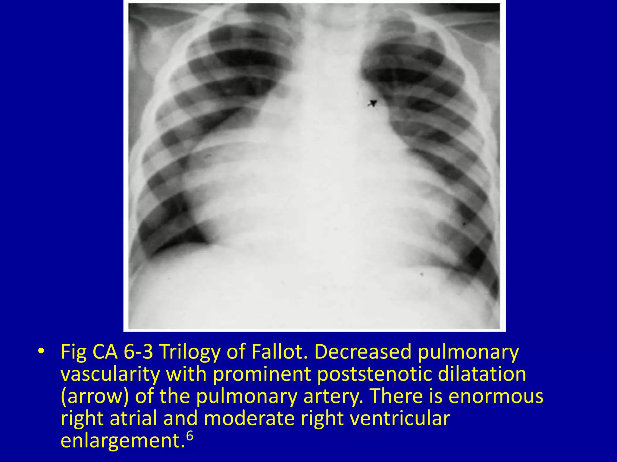6 cyanotic congenital heart disease with decreased pulmonary | PPTX