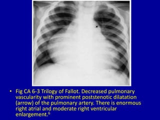6 cyanotic congenital heart disease with decreased pulmonary | PPTX ...