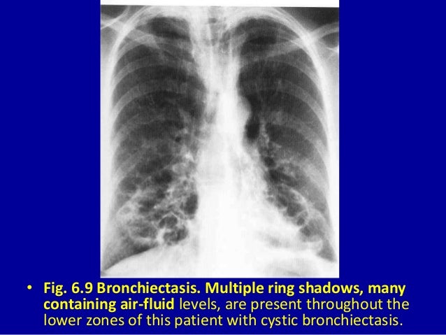 6 diseases of the airways