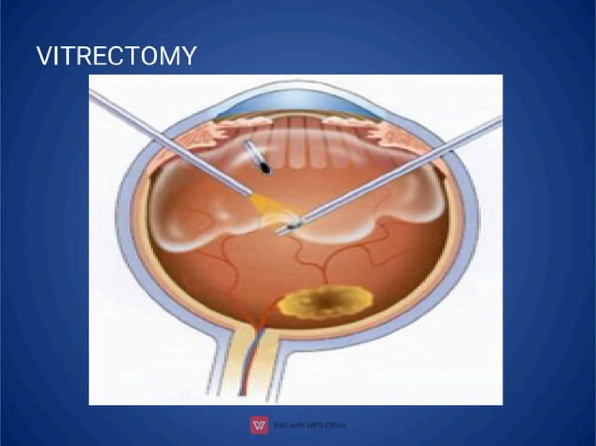 Retinal detachment types of retinal detachment | PDF