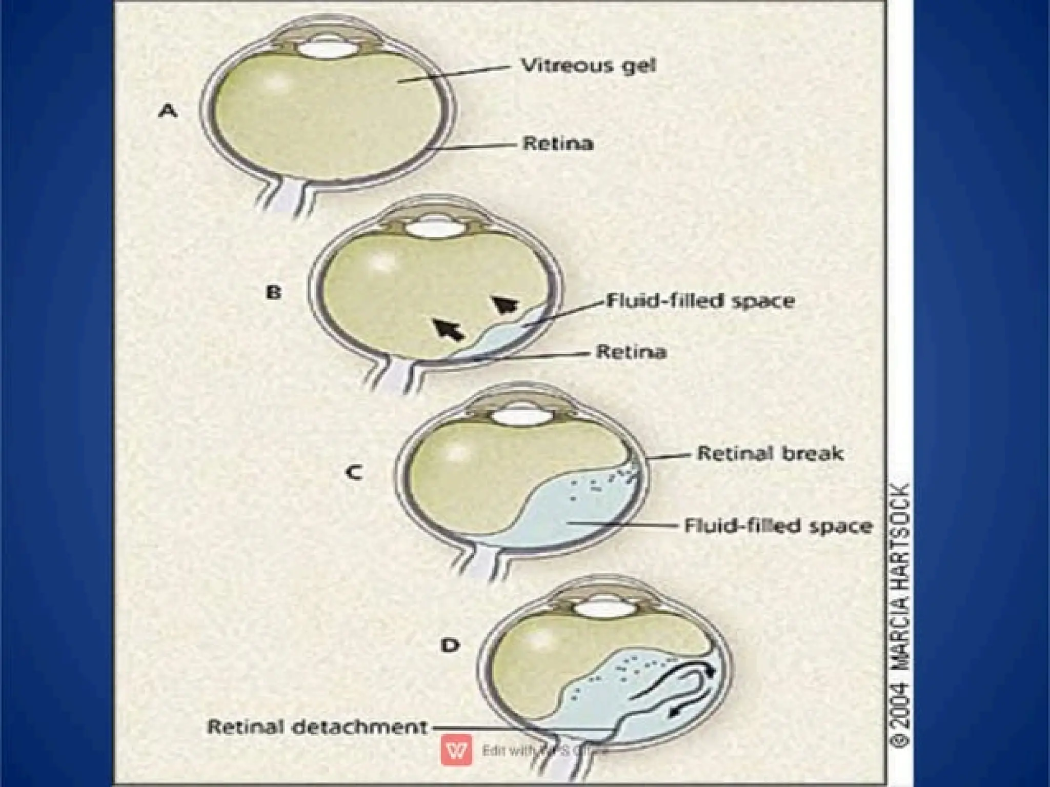 Retinal detachment types of retinal detachment | PDF
