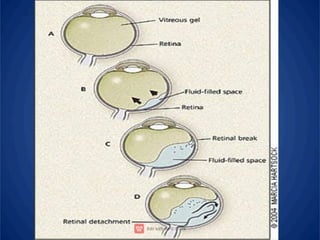Retinal detachment types of retinal detachment | PPT