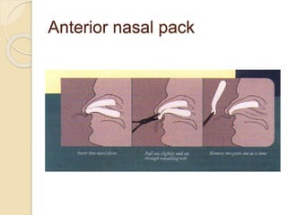 6= EPISTAXIS.pptx