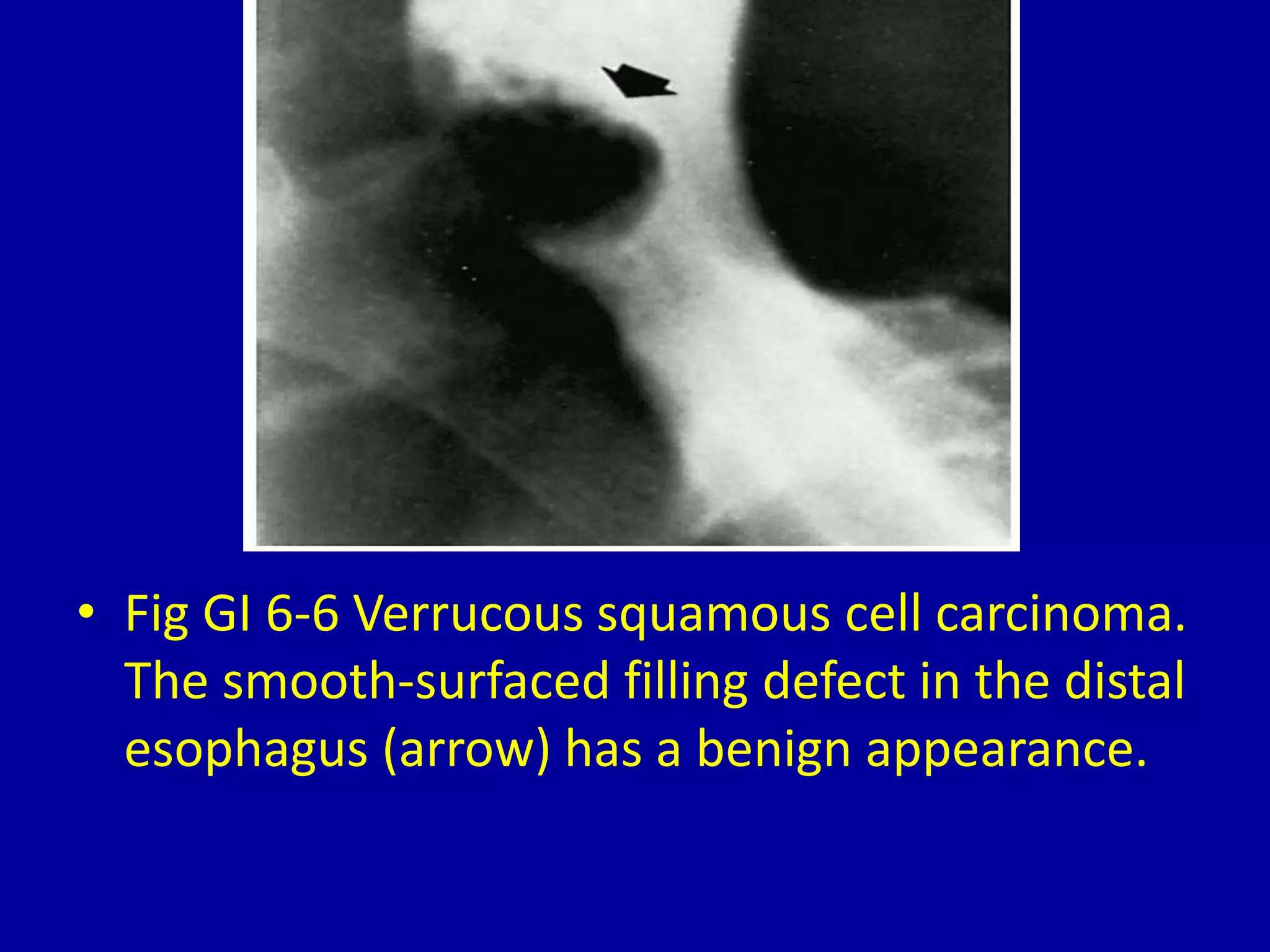 6 esophageal filling defects | PPTX