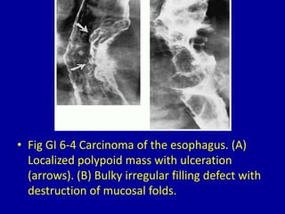 6 esophageal filling defects | PPTX