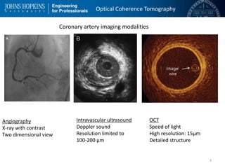 Intracoronary Optical Coherence Tomography (2) | PDF