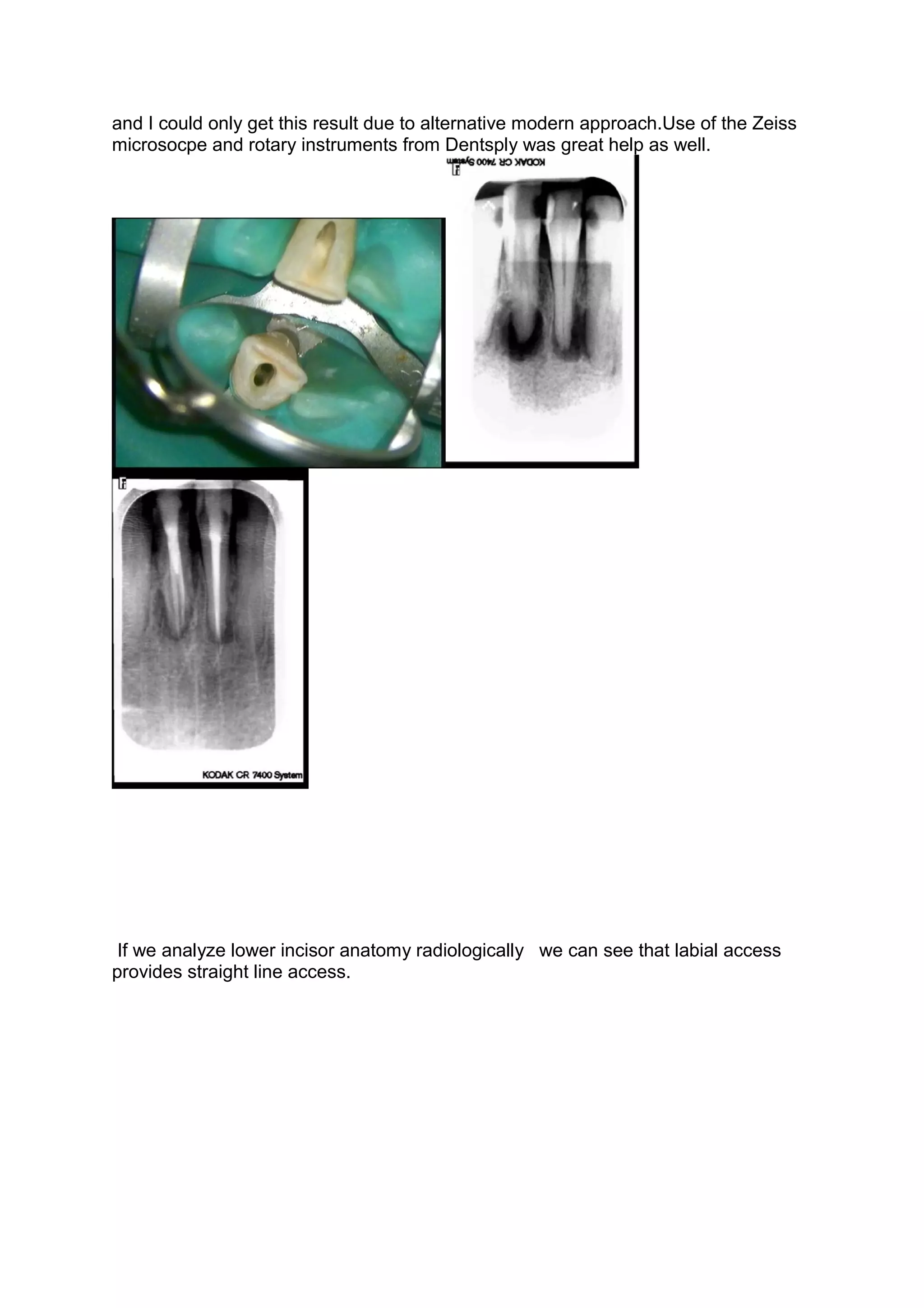 Labial access to lower incisors | DOC