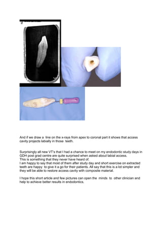 Labial access to lower incisors | PDF