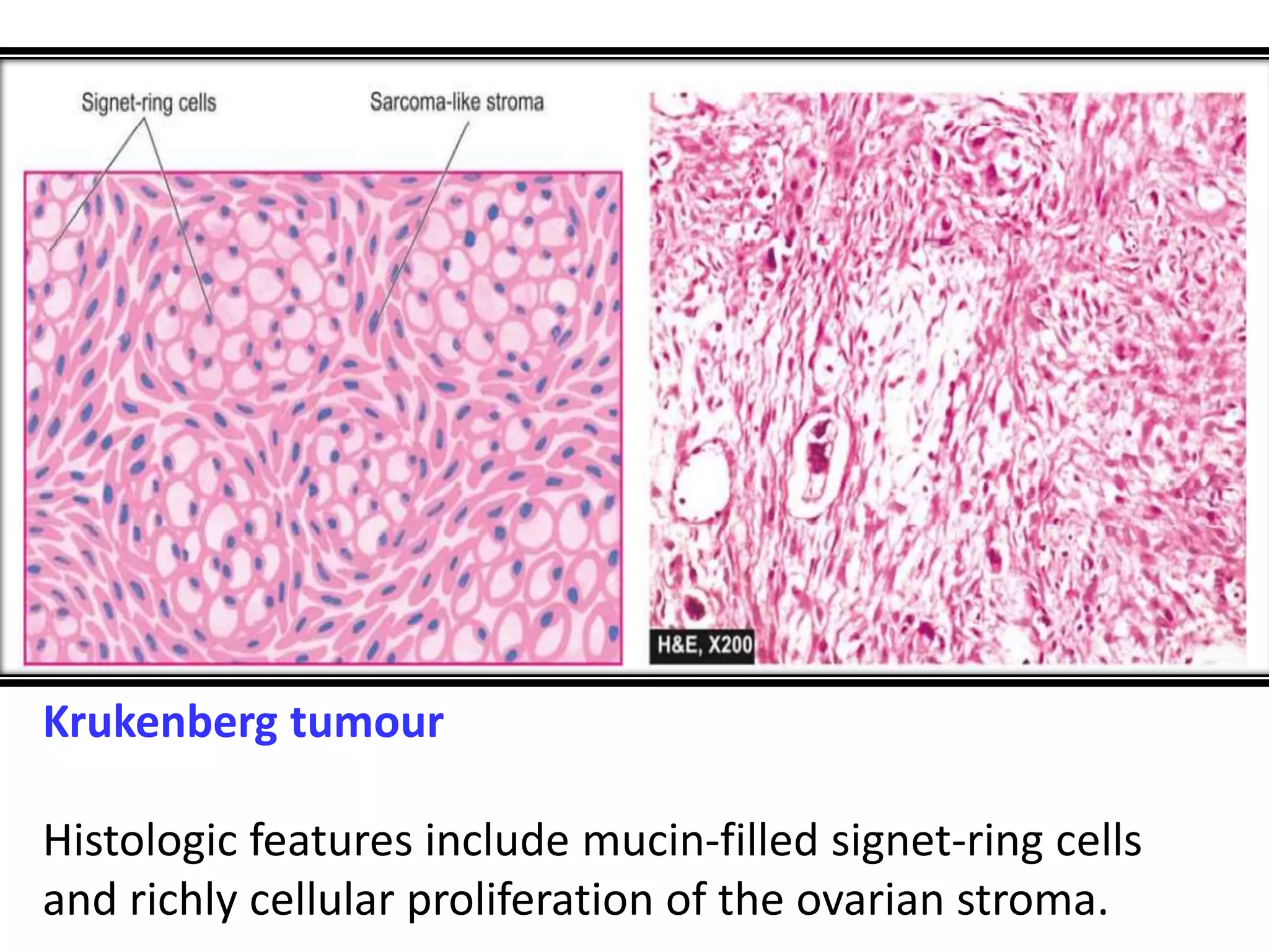 FEMALE GENITAL TRACT: OVARIAN TUMOURS | PPTX