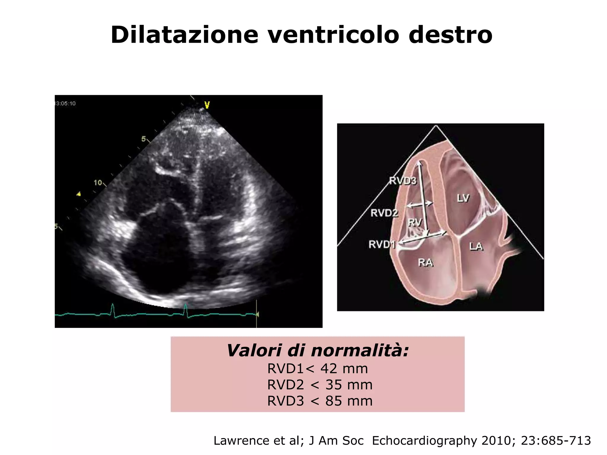 La valutazione ecocardiografica della funzione ventricolare destra | PPTX