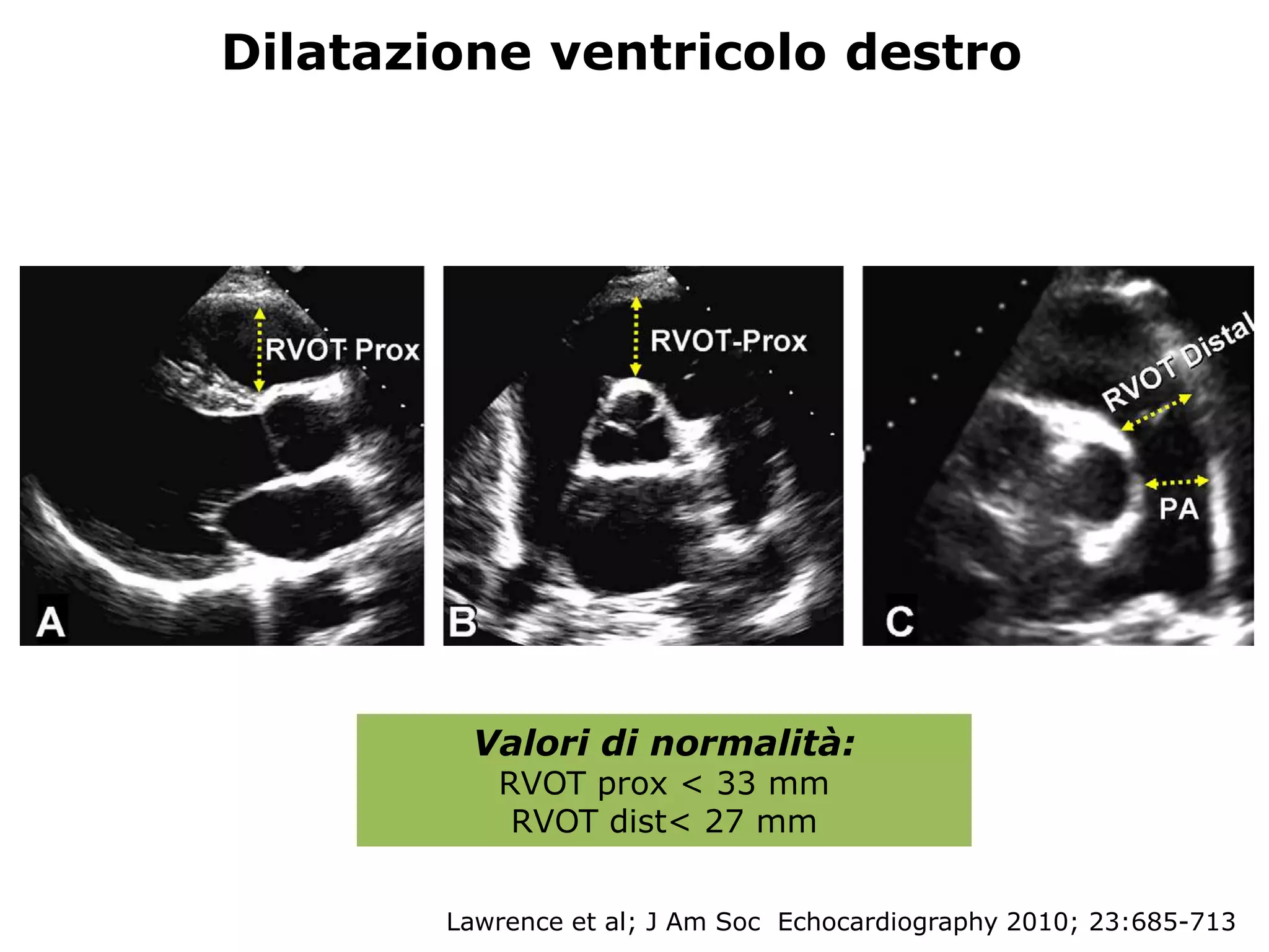 La valutazione ecocardiografica della funzione ventricolare destra | PPTX