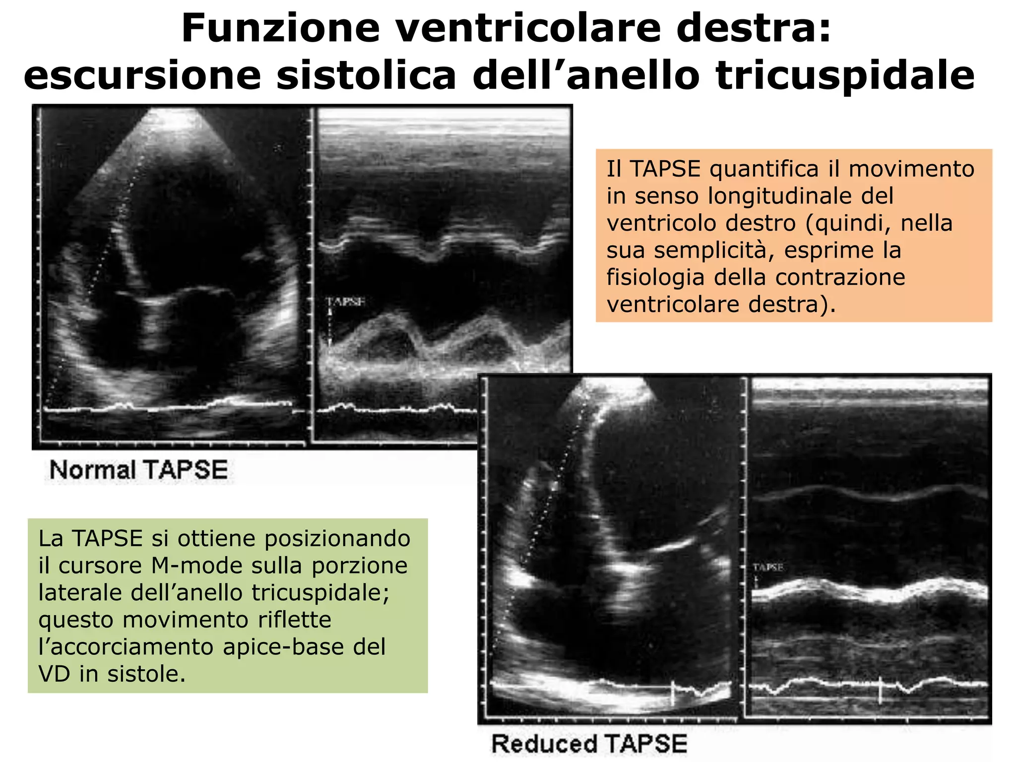 La valutazione ecocardiografica della funzione ventricolare destra | PPTX