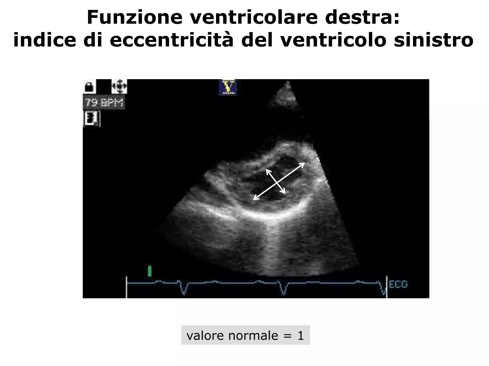 La valutazione ecocardiografica della funzione ventricolare destra | PPTX