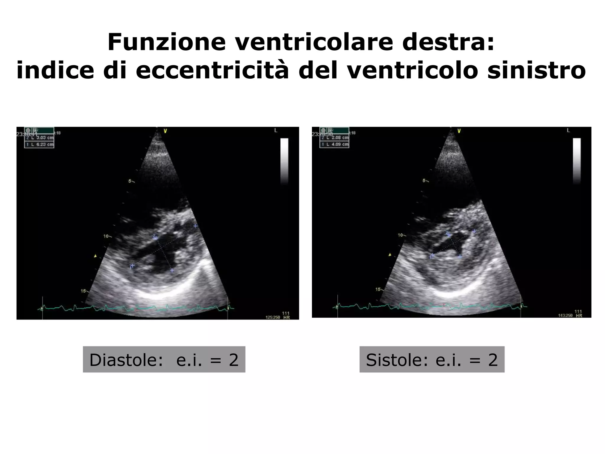 La valutazione ecocardiografica della funzione ventricolare destra | PPTX