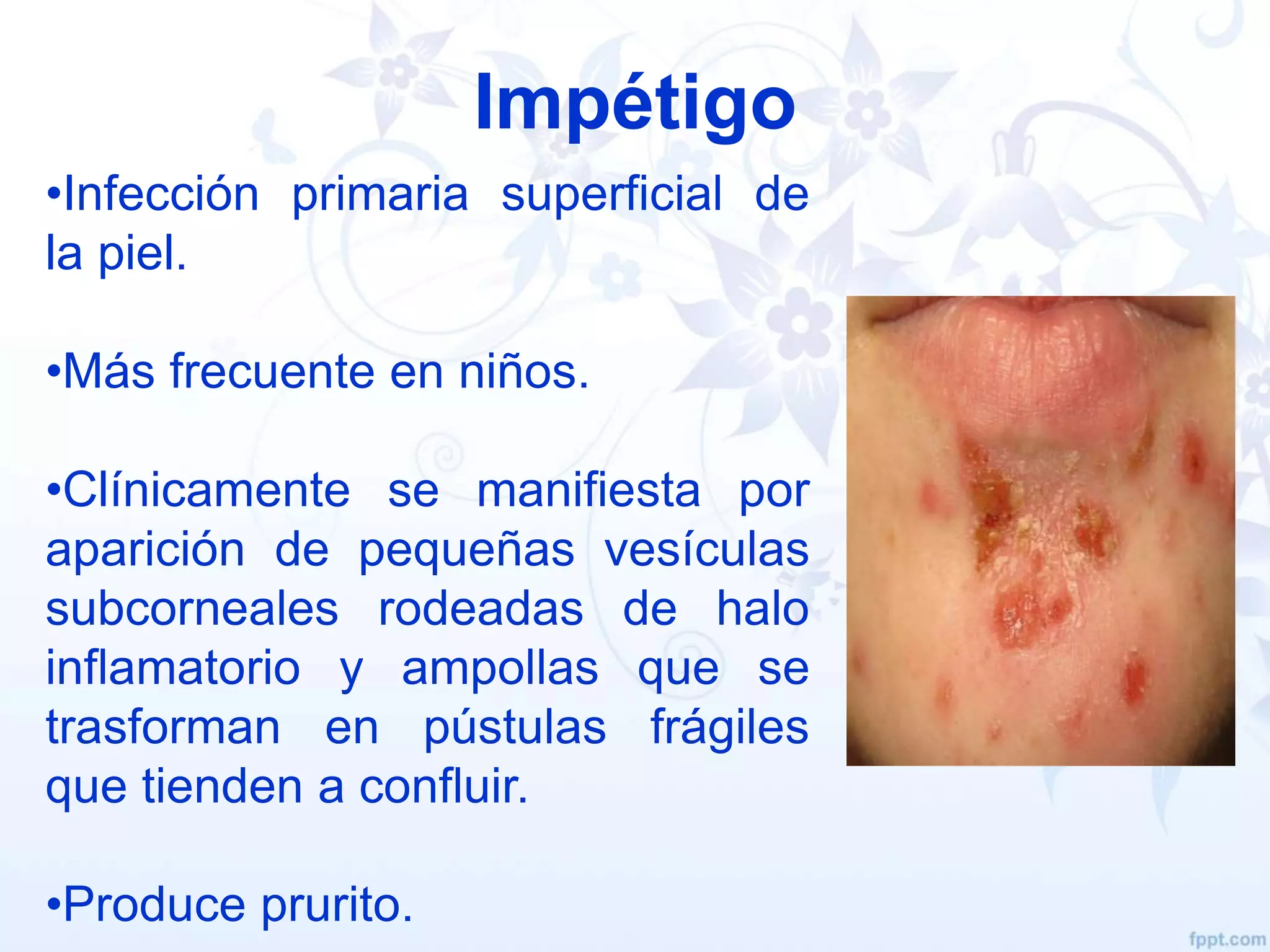 6) Infección de piel y partes blandas-1.ppt