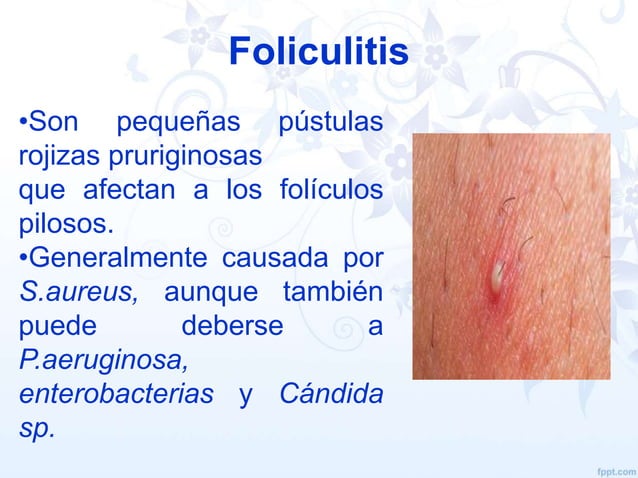 6) Infección de piel y partes blandas-1.ppt