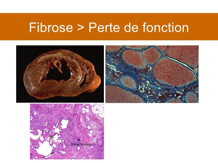 Cours 6. Inflammation et réparation