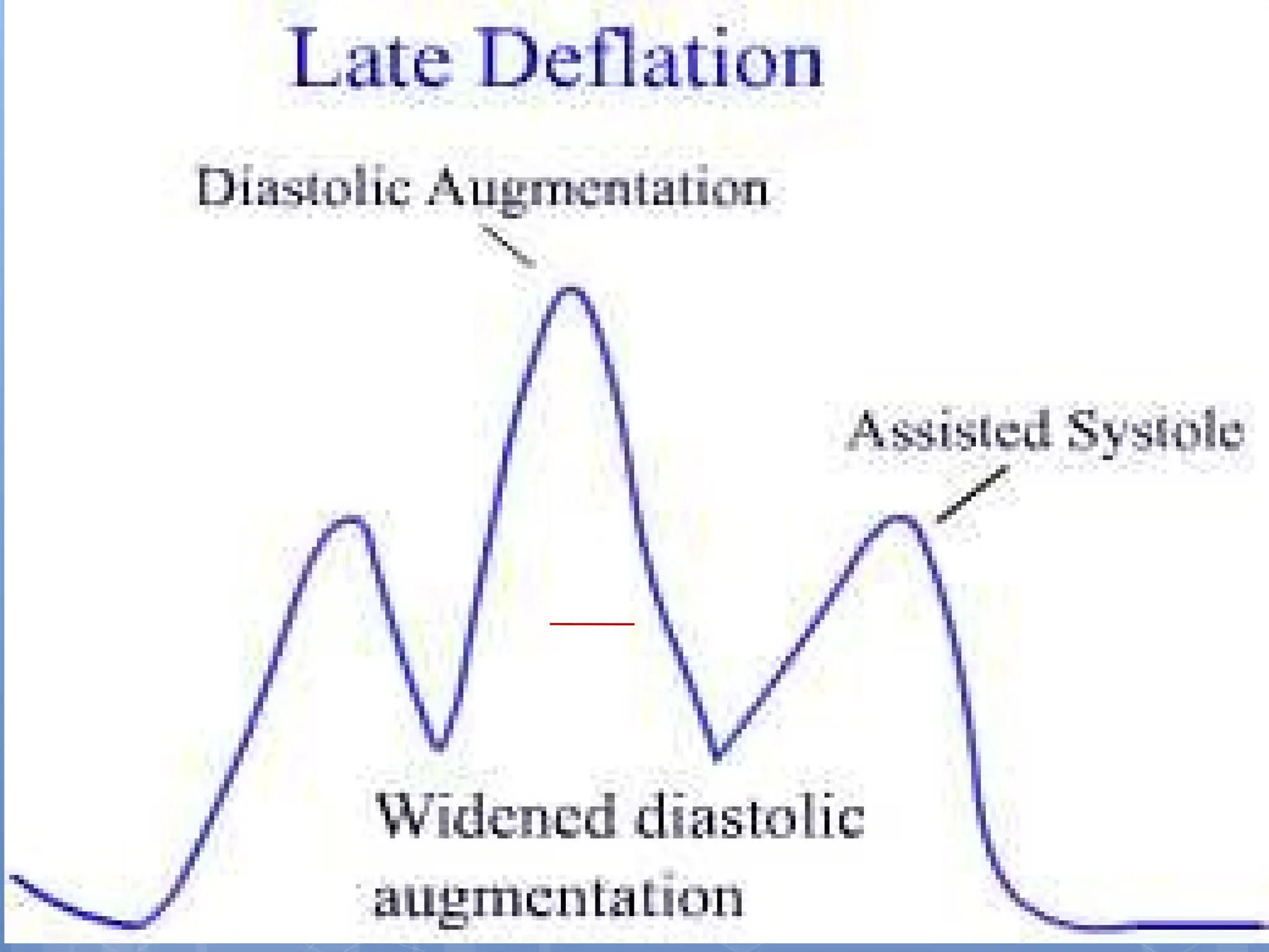 6 Intra-aortic balloon pump monitoring.pptx