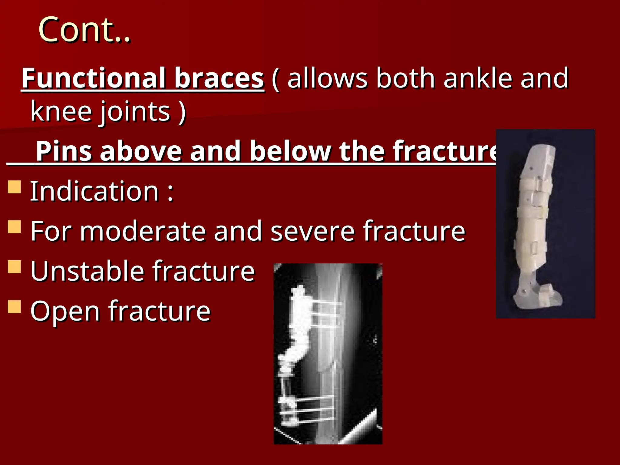 fracture_of_tibia_and_fibula modalities.ppt | Death, Injury, or ...