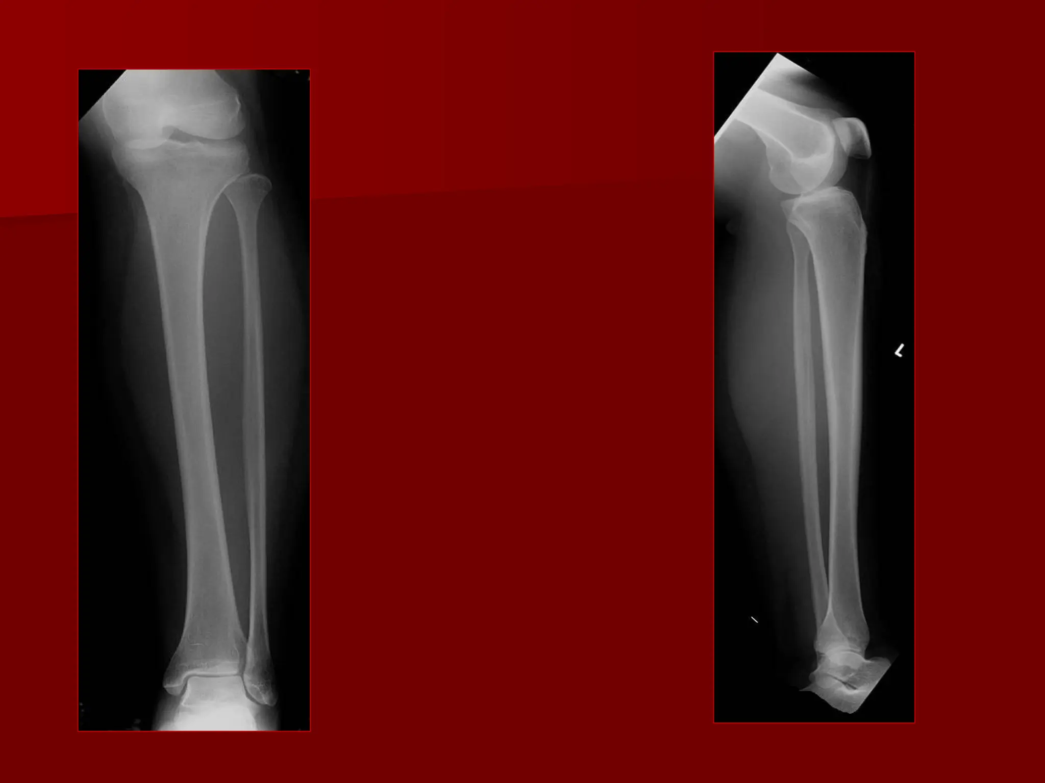 fracture_of_tibia_and_fibula modalities.ppt