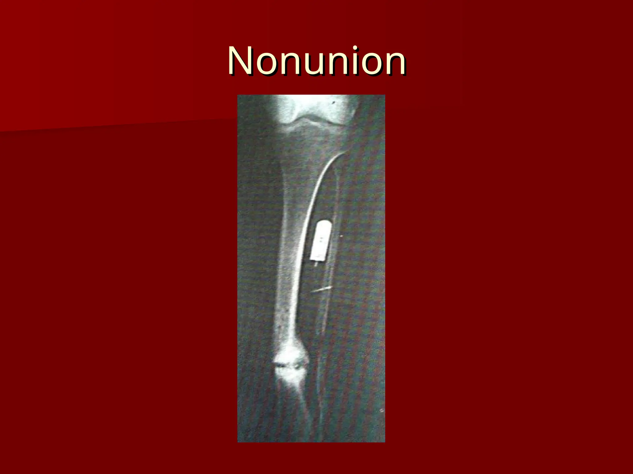 fracture_of_tibia_and_fibula modalities.ppt