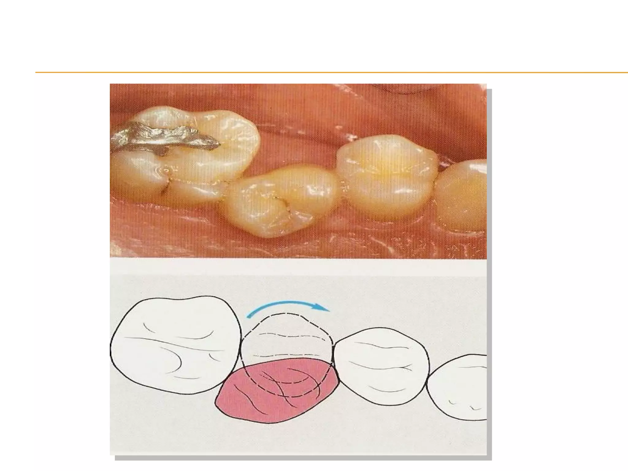 6 keys of occlusion-converted.pdf