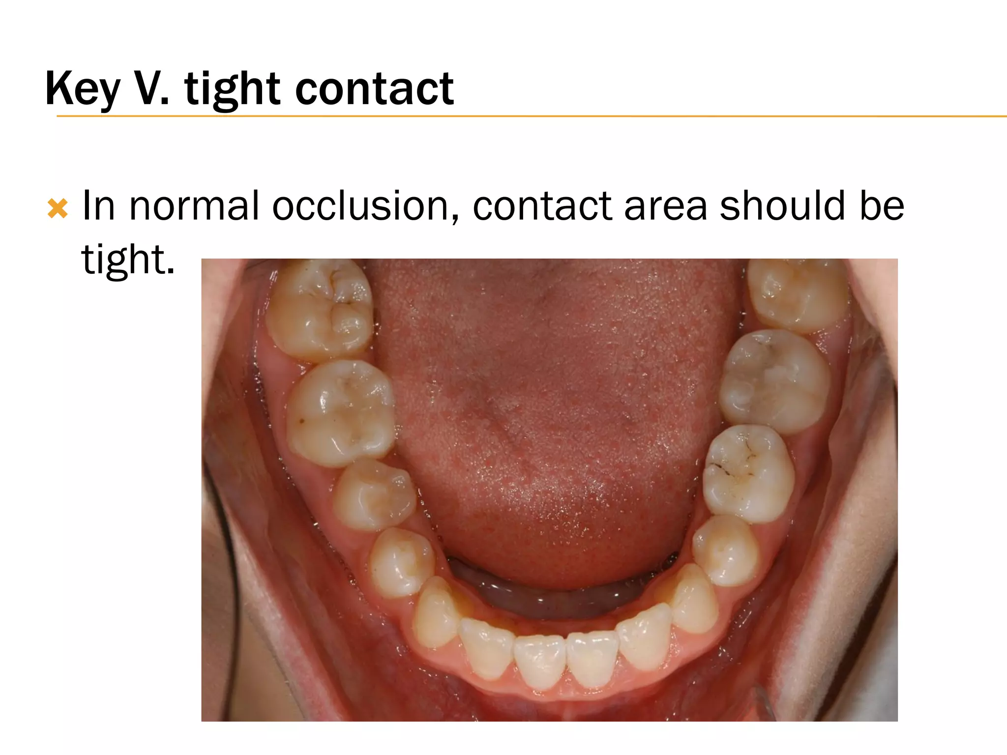 6 keys of occlusion-converted.pdf
