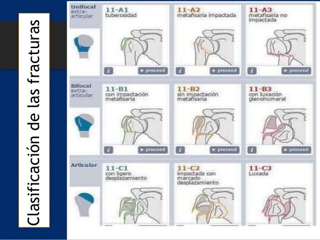 Fracturas de humero proximal AO