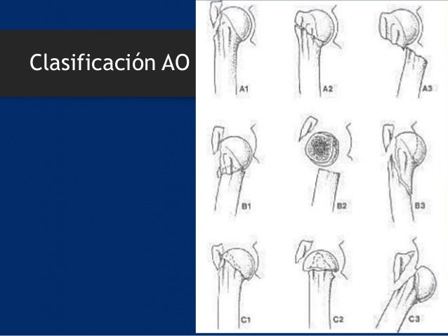 Fracturas de humero proximal AO
