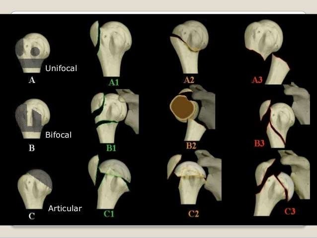 Fracturas de humero proximal AO