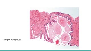 MORPHOLOGICAL PATTERNS OF PROSTATE TUMORS.pptx