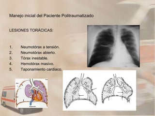 Manejo inicial del Paciente Politraumatizado | PPT