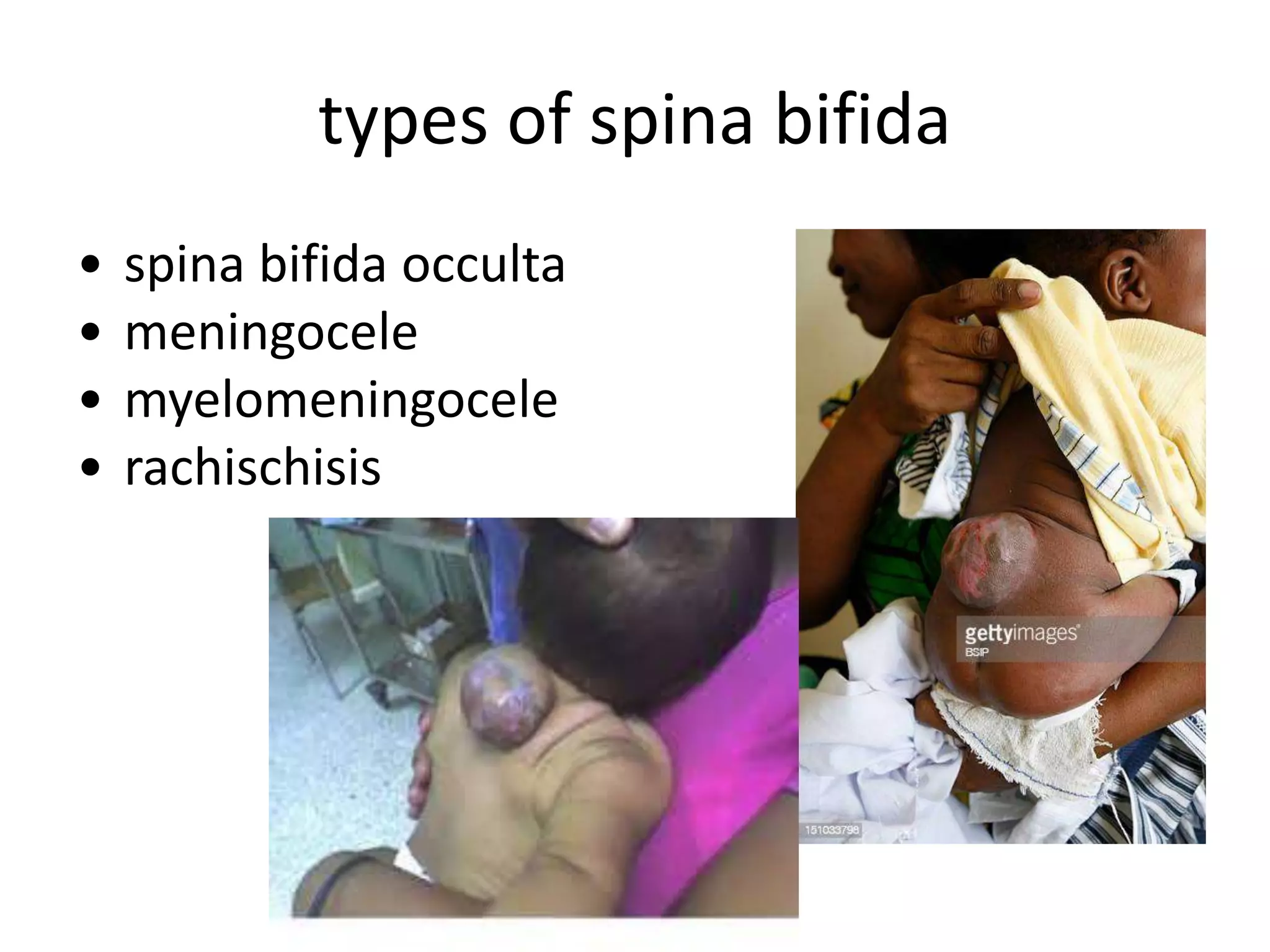6Neural tube defects.pptx