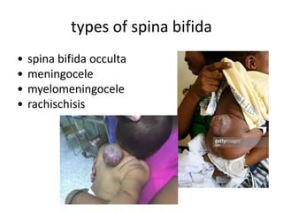6Neural tube defects.pptx | Pregnancy | Reproductive Health