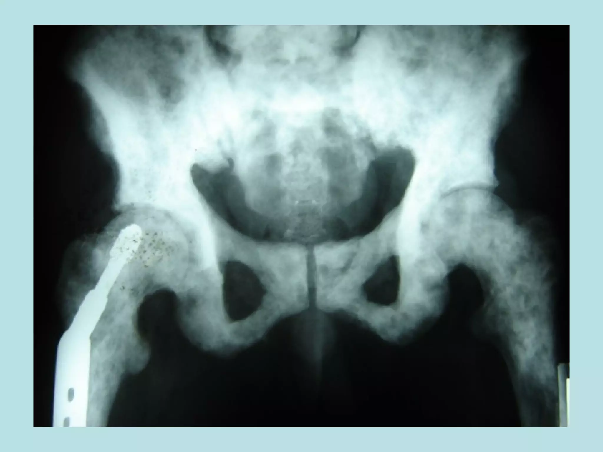 6 obstructive uropathy,acute urinary retention,hematuria | PPT