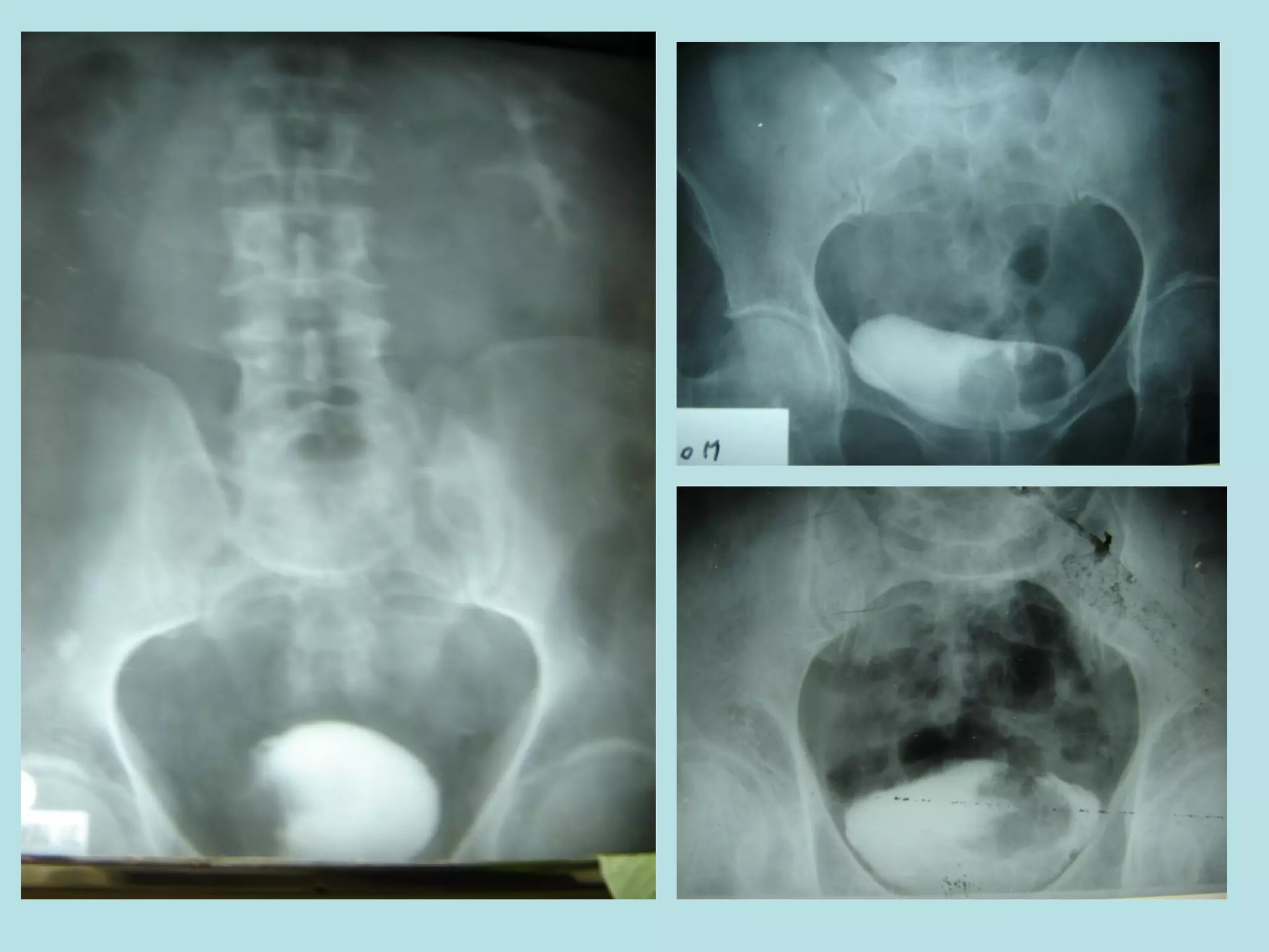 6 obstructive uropathy,acute urinary retention,hematuria | PPT