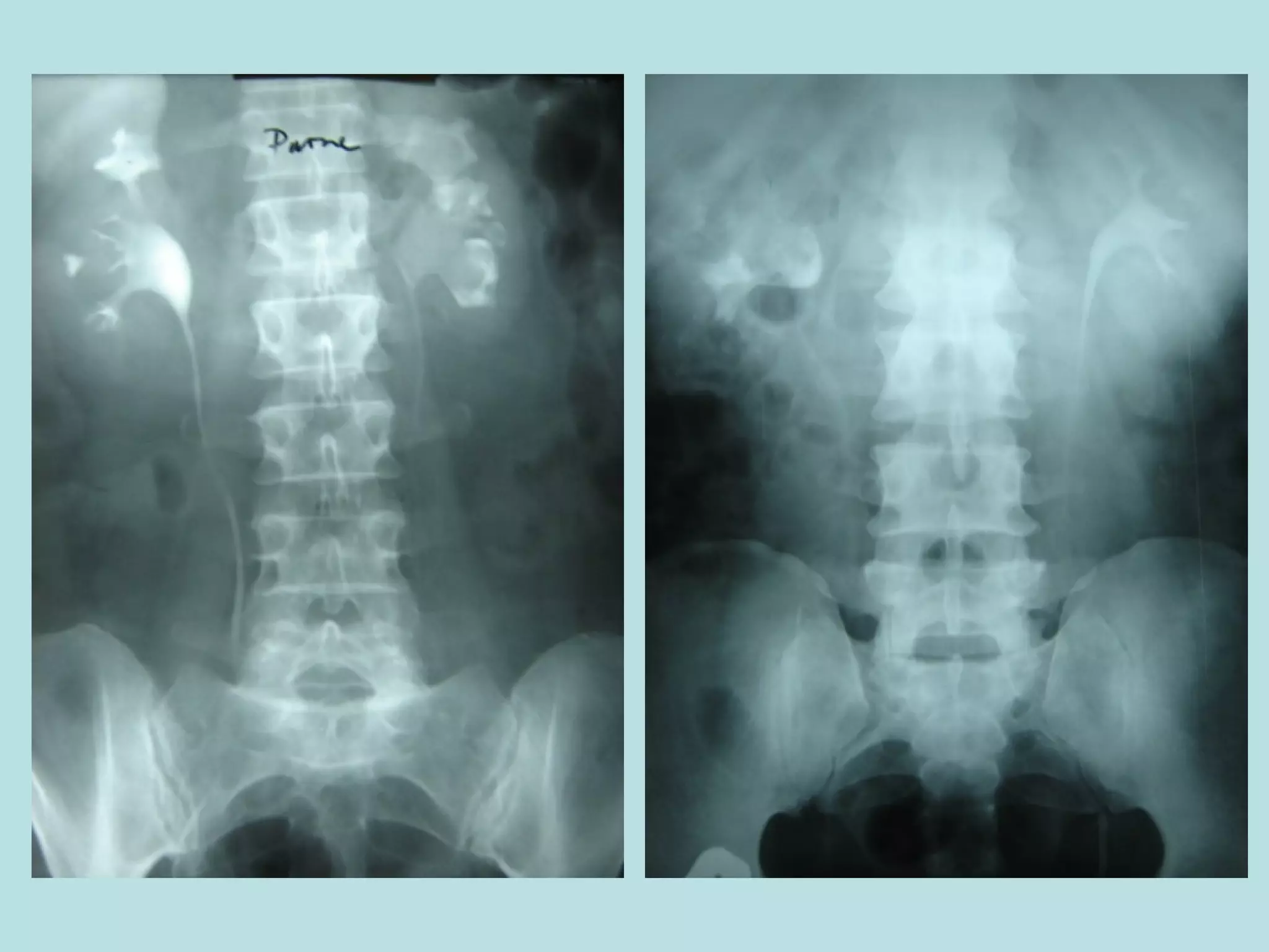 6 obstructive uropathy,acute urinary retention,hematuria | PPT