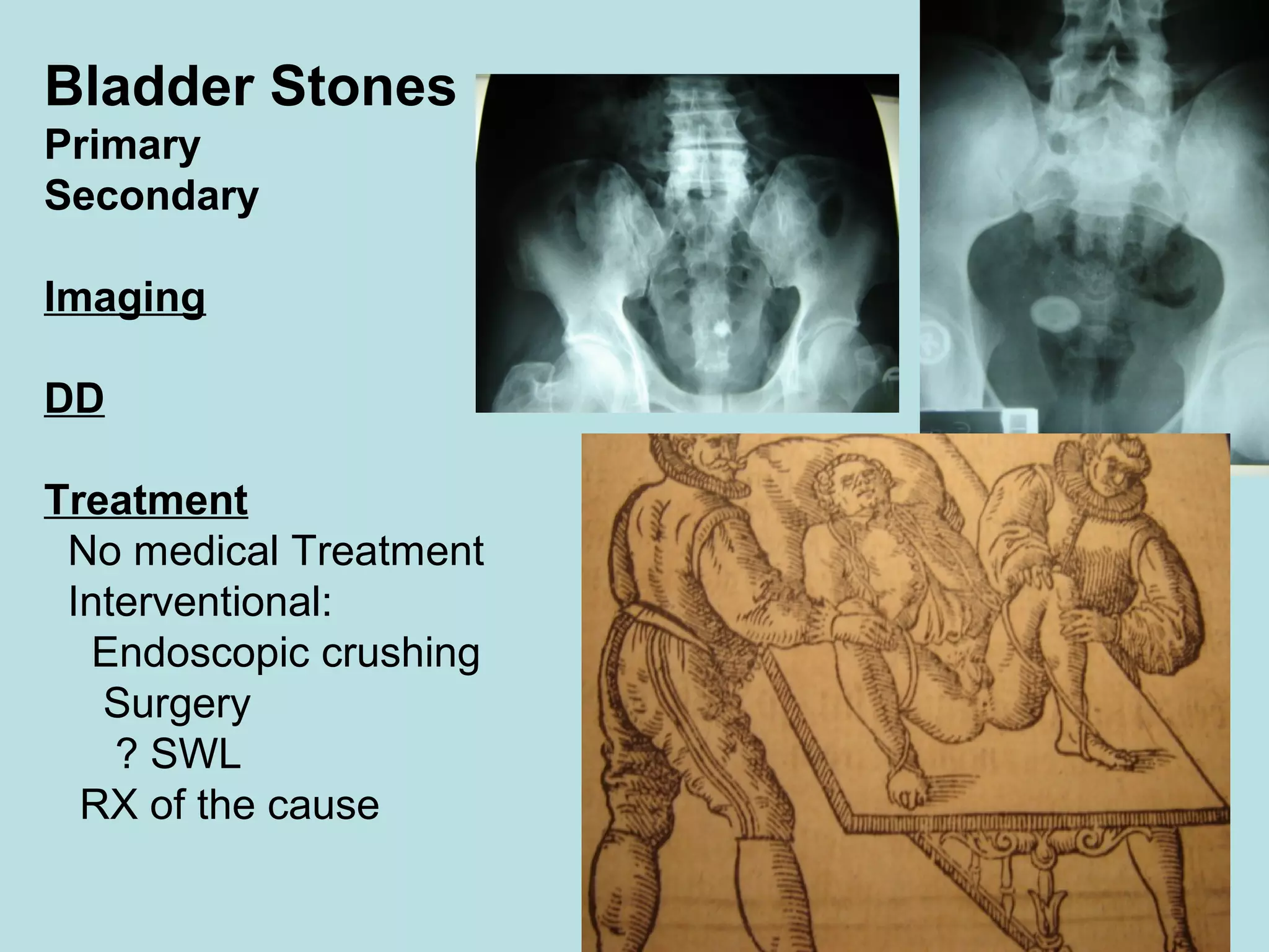 6 obstructive uropathy,acute urinary retention,hematuria | PPT