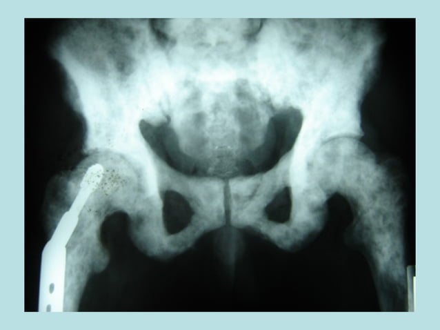 6 obstructive uropathy,acute urinary retention,hematuria | PPT | Cancer ...