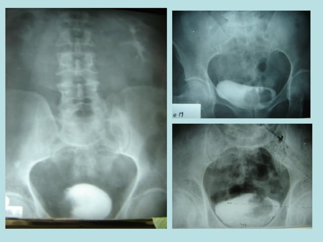 6 obstructive uropathy,acute urinary retention,hematuria | PPT | Cancer ...